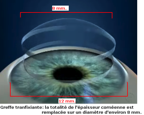 Greffe de Cornée - Pr. Maher SALEH - Ophtalmologue